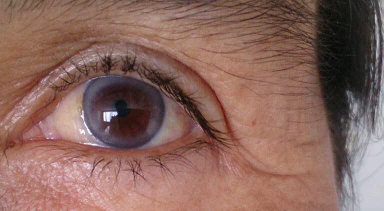 High Cholesterol (Hypercholesterolemia) Symptoms & Signs You Should ...