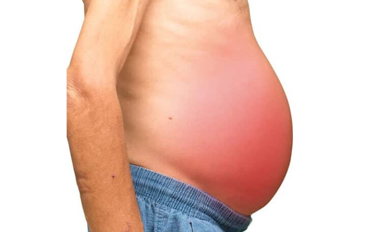12 Symptoms And Early Signs Of Fatty Liver (Hepatic Steatosis ...