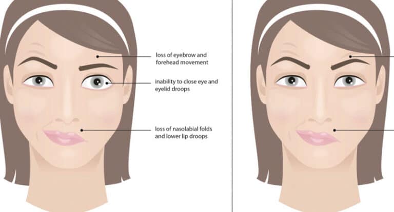 10 Symptoms of Vertigo (Early Signs To Be Aware Of) - OptingHealth