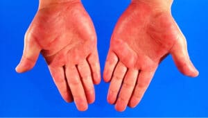 12 Symptoms And Early Signs Of Fatty Liver (Hepatic Steatosis ...