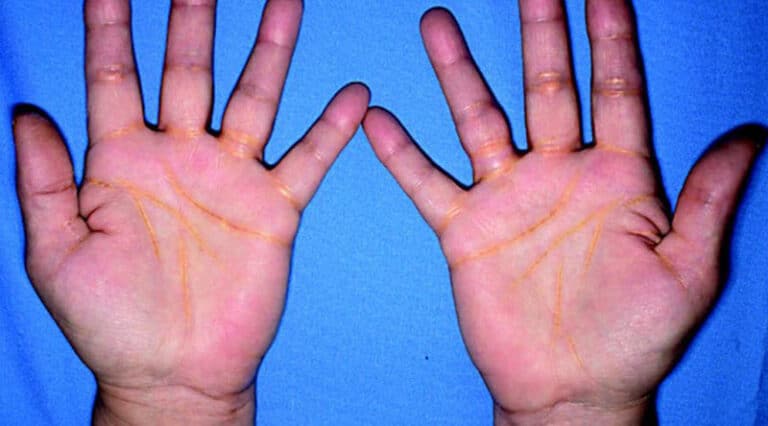 High Cholesterol (Hypercholesterolemia) Symptoms & Signs You Should ...