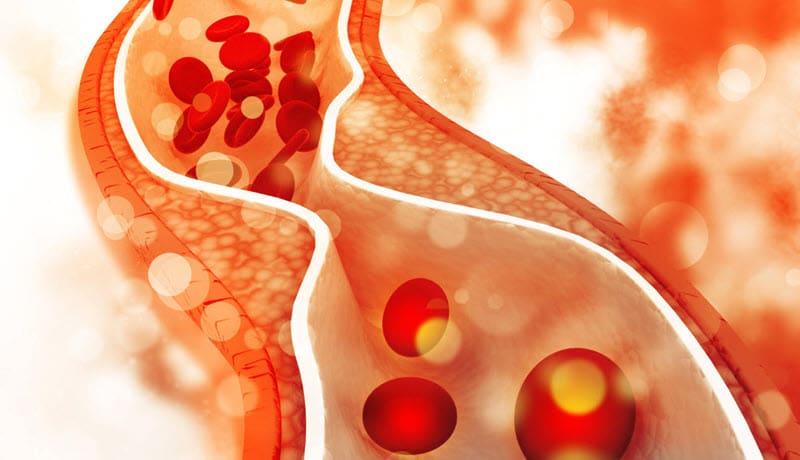 High Cholesterol (Hypercholesterolemia) Symptoms & Signs You Should ...