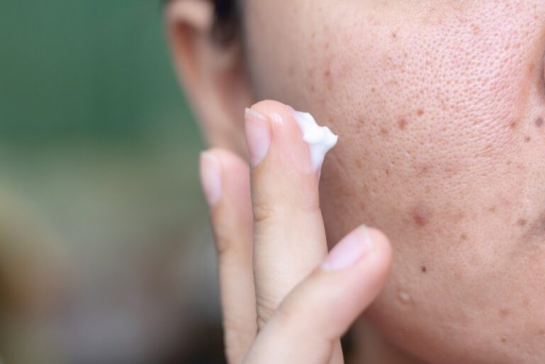 How To Treat Best Acne: 14 Treatments Professionals Recommend ...