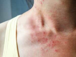 14 Symptoms Of Enlarged Liver (Early Warning Signs) - OptingHealth