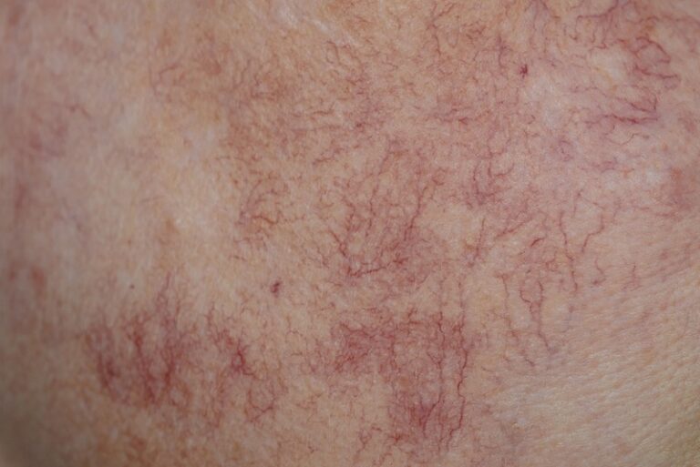 11 Symptoms & Sign Of Cirrhosis (Don't Ignore) - OptingHealth