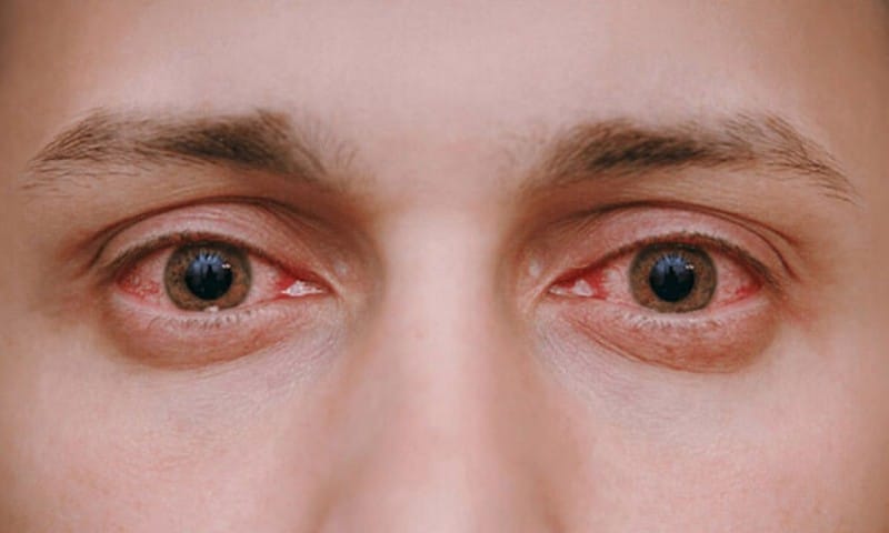 What Could Cause Burning Eyes? 12 Possible Triggers (List) - OptingHealth