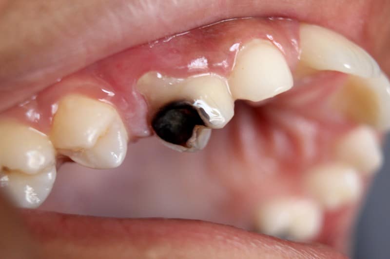14 Best Home Remedies To Treat Cavities Naturally - OptingHealth
