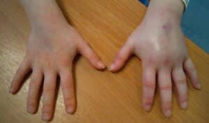 12 Common Signs Of Blood Clot In Arm You Shouldn't Ignore (List ...
