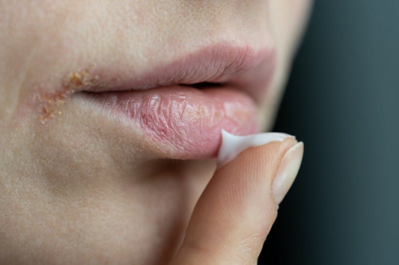 14 At-Home, All-Natural Remedies For Chapped Lips - OptingHealth