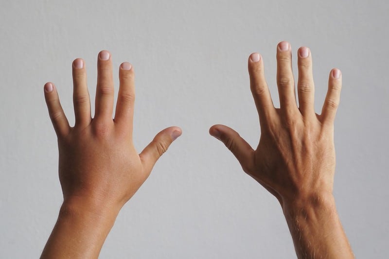 15 Causes & Triggers of Hand Swelling You Shouldn't Ignore (List ...