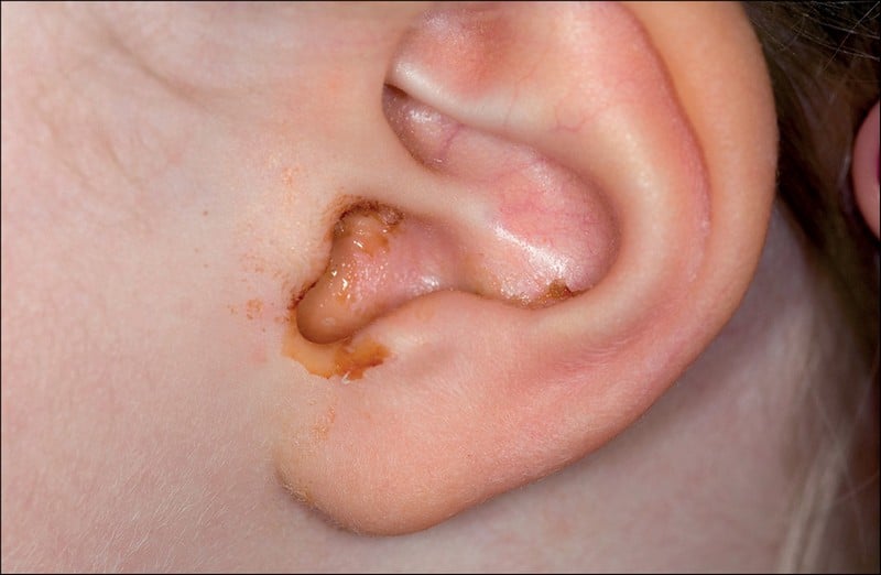 What Are The Causes Of Ear Pressure? 12 Common Triggers - OptingHealth