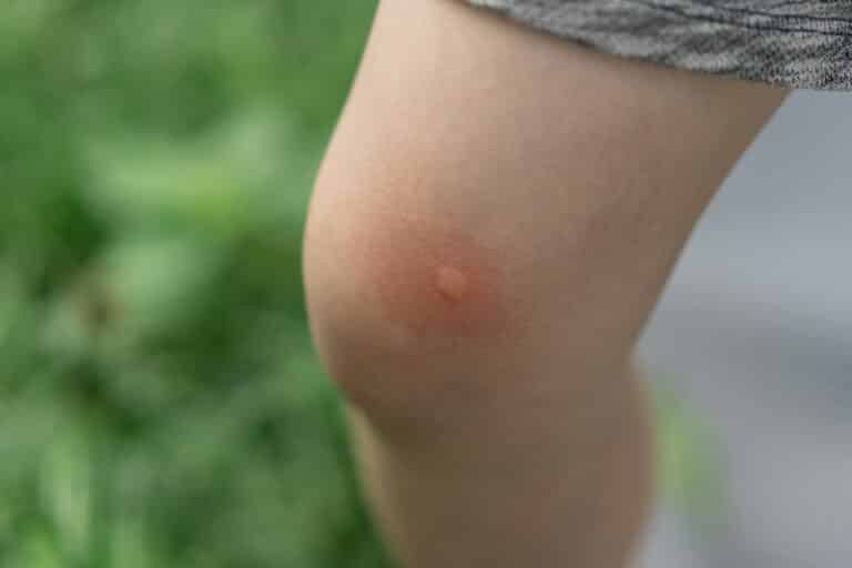 What Are The Triggers Of Petechiae? 10 Common Causes - OptingHealth