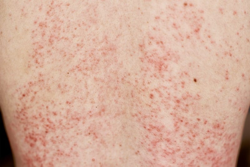 The 13 Causes of Back Acne (You Should Definitely Be Aware Of ...
