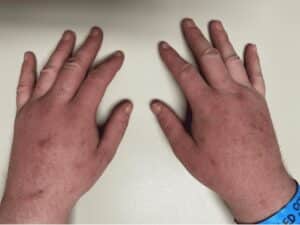 15 Causes & Triggers of Hand Swelling You Shouldn't Ignore (List ...