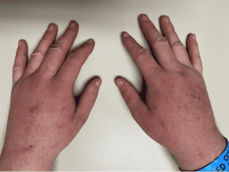 15 Causes & Triggers of Hand Swelling You Shouldn't Ignore (List ...