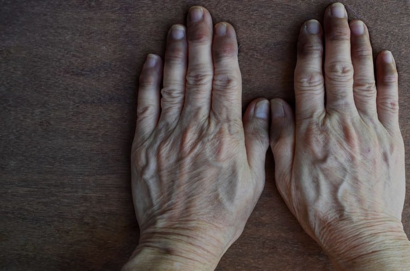 Early Signs Of Sepsis: 14 Symptoms - OptingHealth