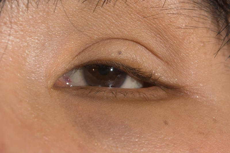 What Causes Sunken Eyes? 12 Common Causes (You Should Know) - OptingHealth