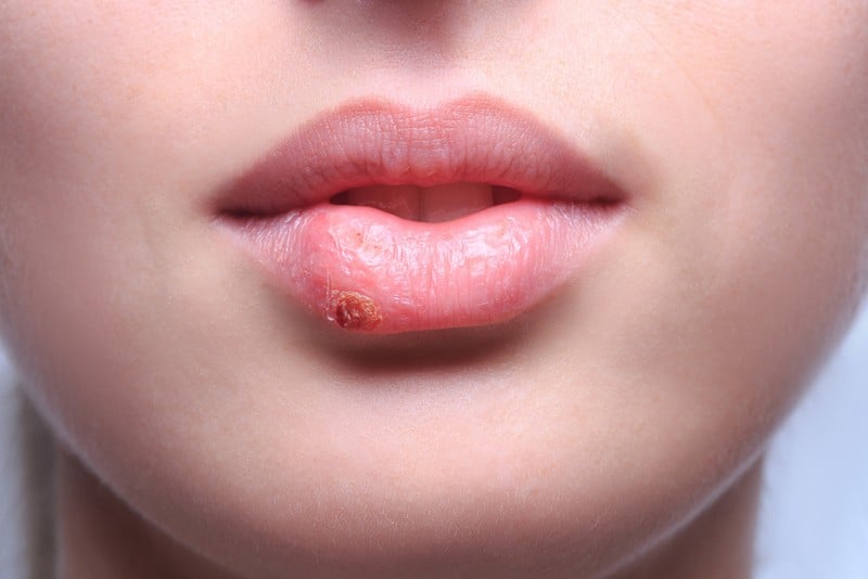 The 13 Causes of Swollen Lips (You Should Definetly Be Aware Of ...