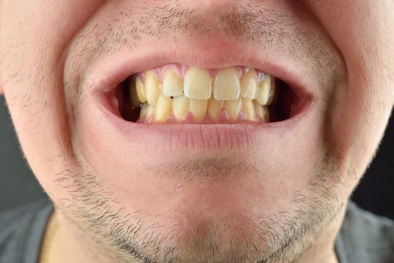 What Causes Yellow Teeth? 14 Common Causes (You Should Know) - OptingHealth